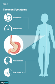 Understanding and Managing Gastroesophageal Reflux Disease (GERD)